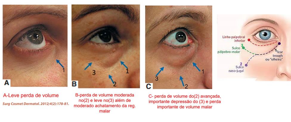 PREENCHIMENTO MALAR - CLÍNICA BELLA PELLE